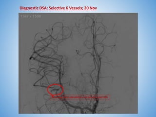 Endovascular Coil Embolization of Dissecting distal MCA Aneurysm with ...