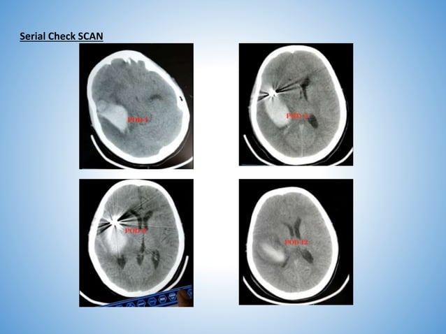 Endovascular Coil Embolization of Dissecting distal MCA Aneurysm with ...