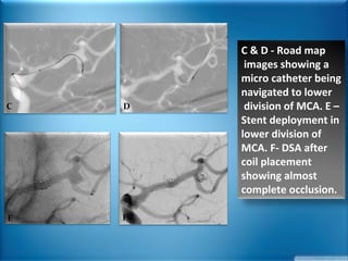 Dissecting MCA Aneurysm | PPT