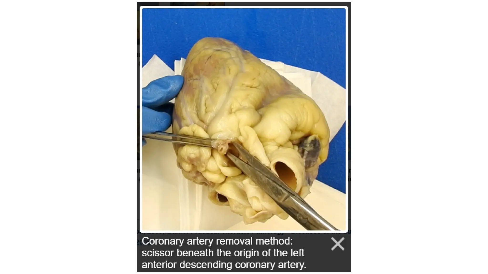 dissection of heart.pptxdjfewioufjewilfewmpfoeiwfe | PPTX