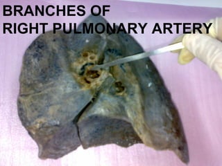Pulmonary Trunk Cadaver