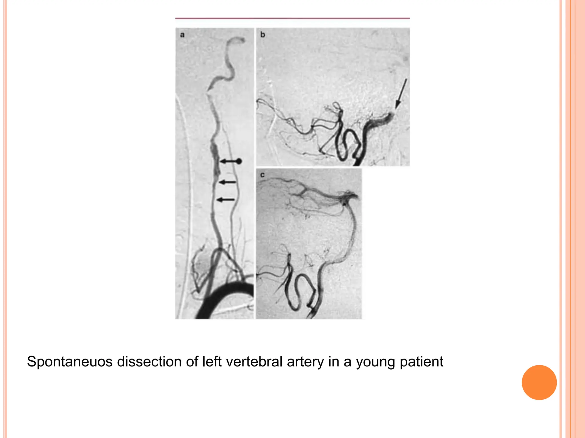 Dissections..intra and extracranila.pptx
