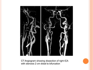 Dissections..intra and extracranila.pptx