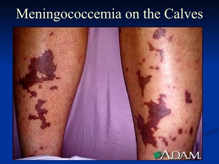 Disseminated Intravascular Coagulation Causes Symptoms