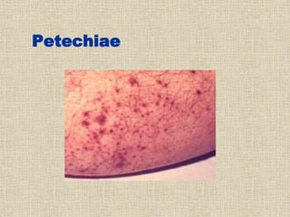 Disseminated intravascular coagulation ppt | PPTX