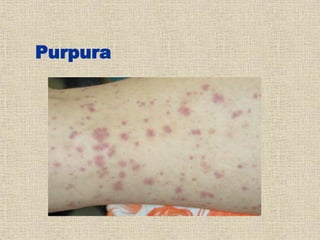 Disseminated intravascular coagulation ppt | PPTX