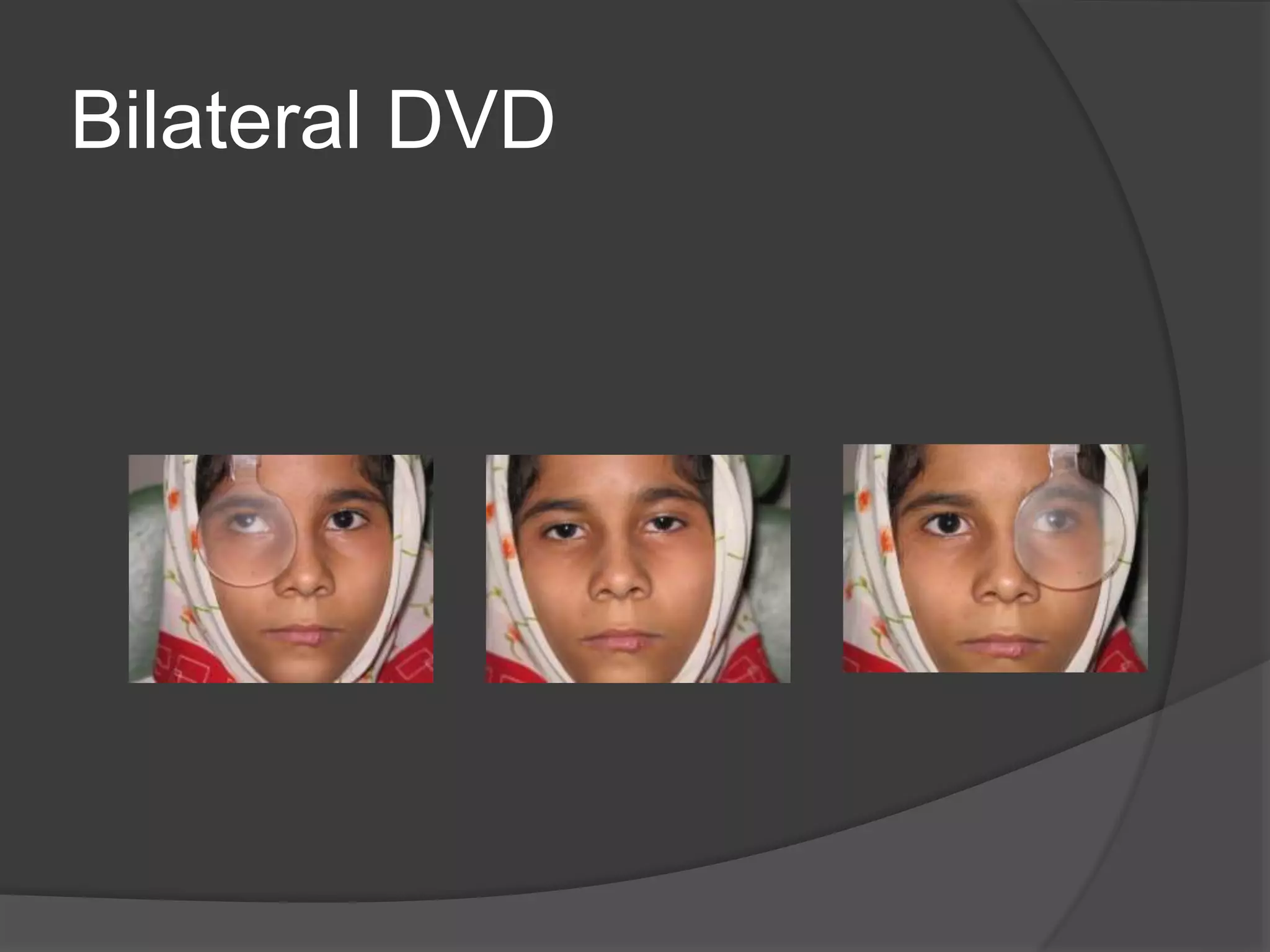 Dissociated Vertical Deviation (DVD) | PPTX