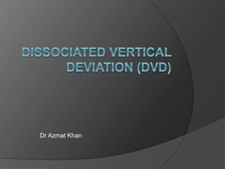 Dissociated Vertical Deviation (DVD) | PPTX