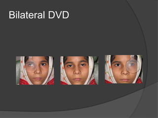Dissociated Vertical Deviation (DVD) | PPTX