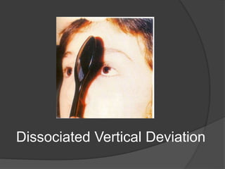 Dissociated Vertical Deviation (DVD) | PPTX