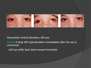 Dissociated Vertical Deviation (DVD) | PPTX