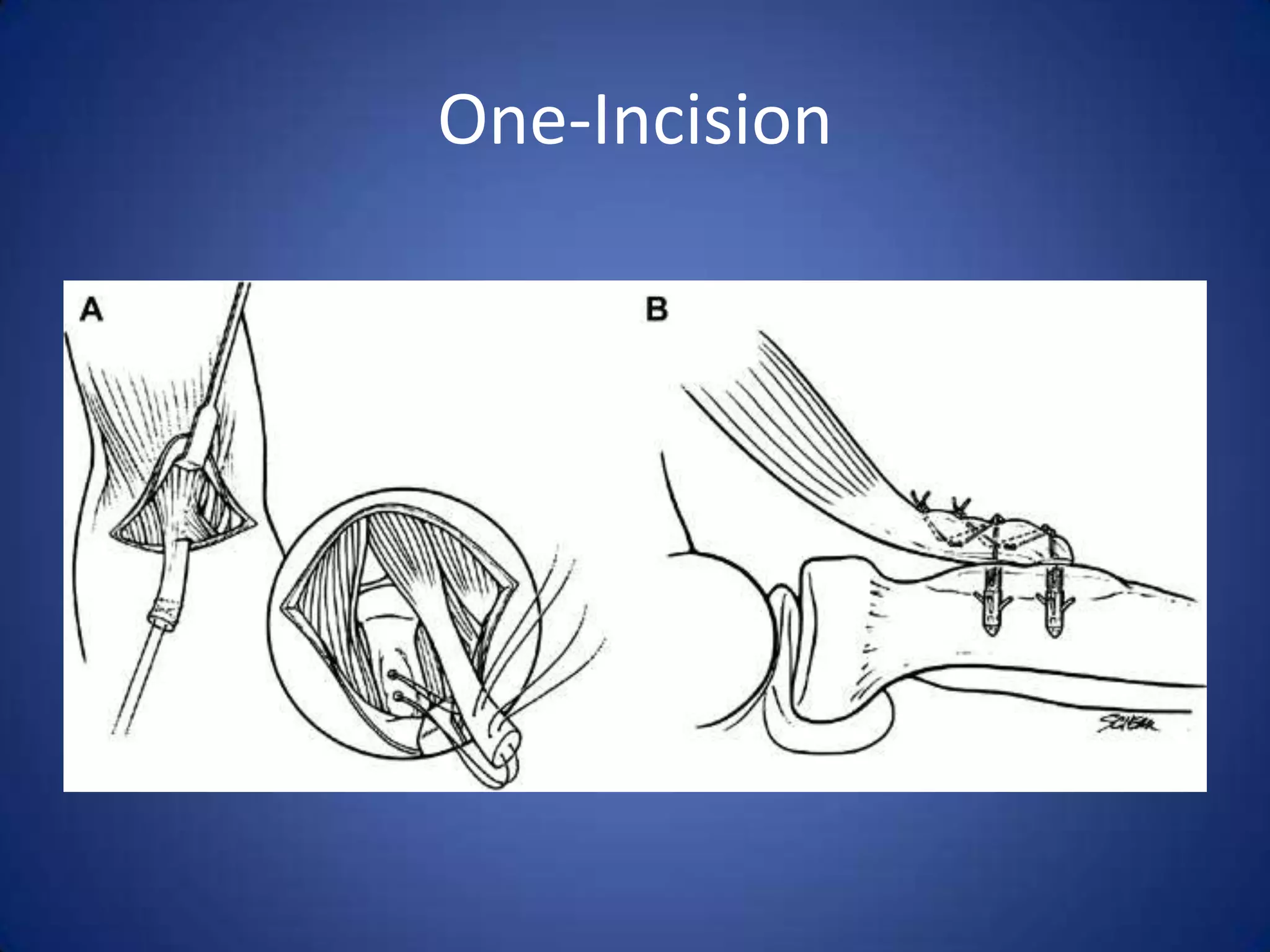 Management of Distal Biceps Injuries in Athletes | PPTX