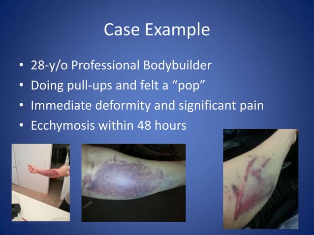 Management of Distal Biceps Injuries in Athletes | PPTX | Death, Injury ...