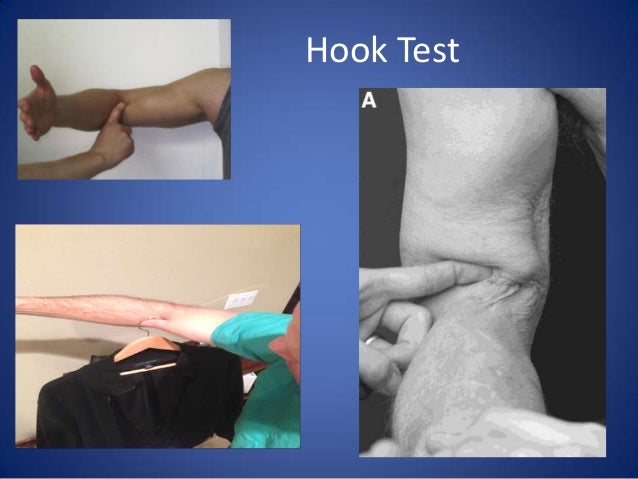 Management Of Distal Biceps Injuries In Athletes