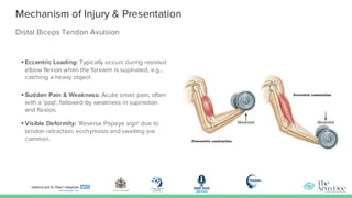 Distal Biceps Avulsion presentation and treatment options | PDF