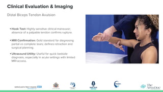 Distal Biceps Avulsion presentation and treatment options | PDF
