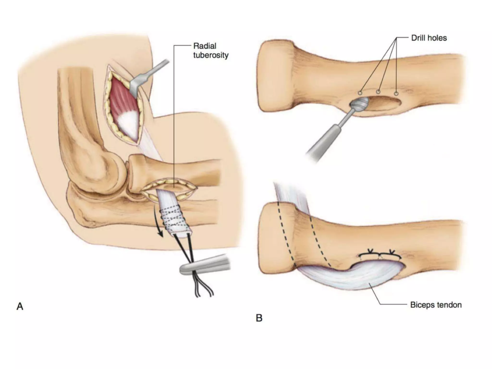 Distal Biceps Tendon Rupture | PPTX