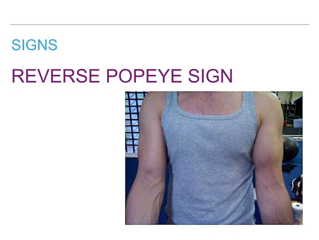 Distal Biceps Tendon Rupture | PPTX