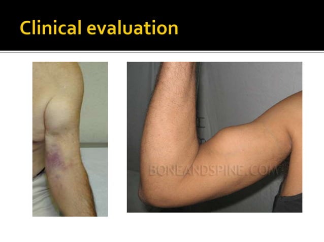 Distal biceps tendon rupture - by Hussain Algawahmed | PPTX | Death ...