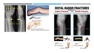 Distal end of radius fracture(1) (2).pptx