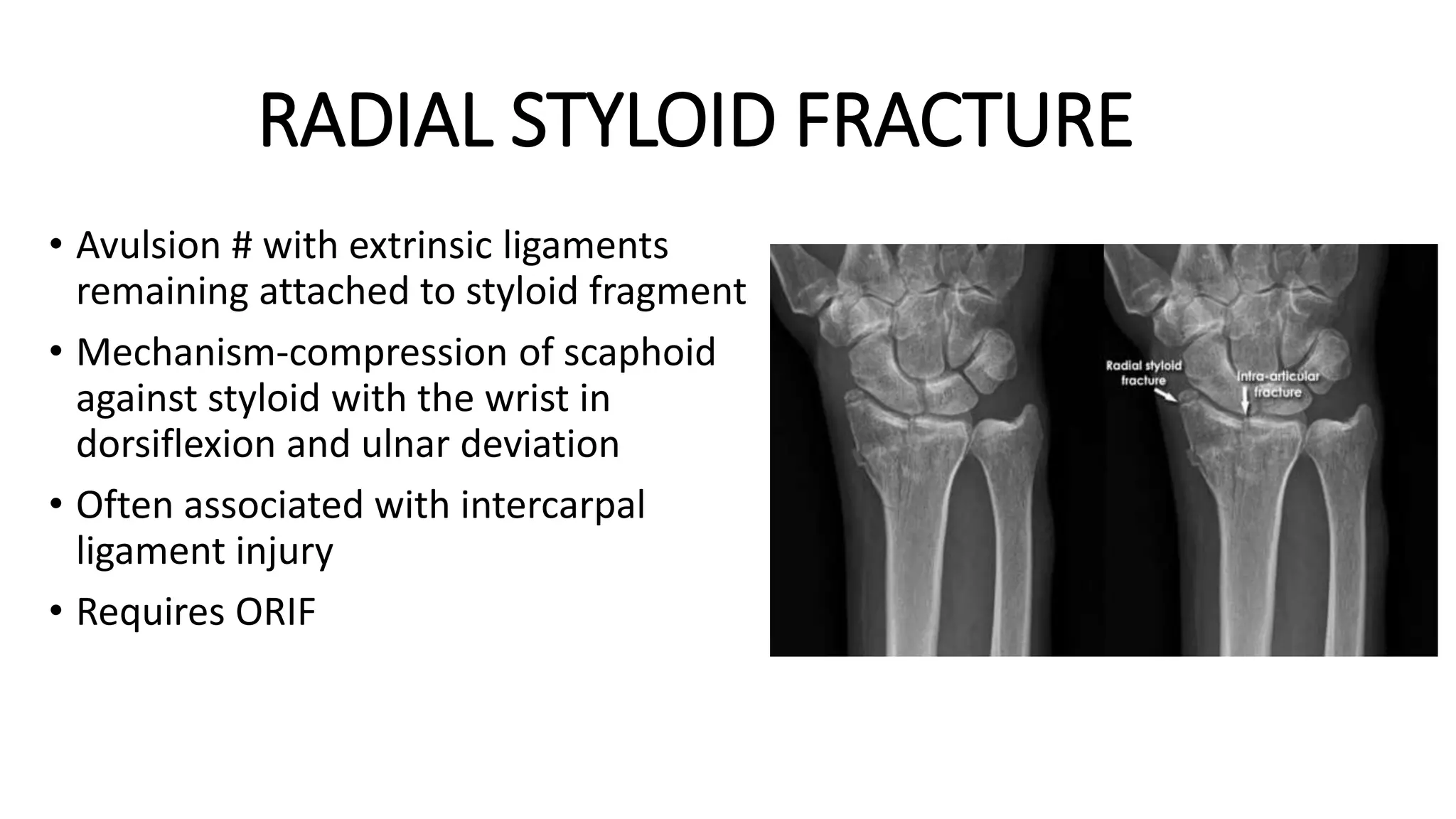 DISTAL END OF RADIUS FRACTURE AND DISLOCATION MANAGEMENT.pptx