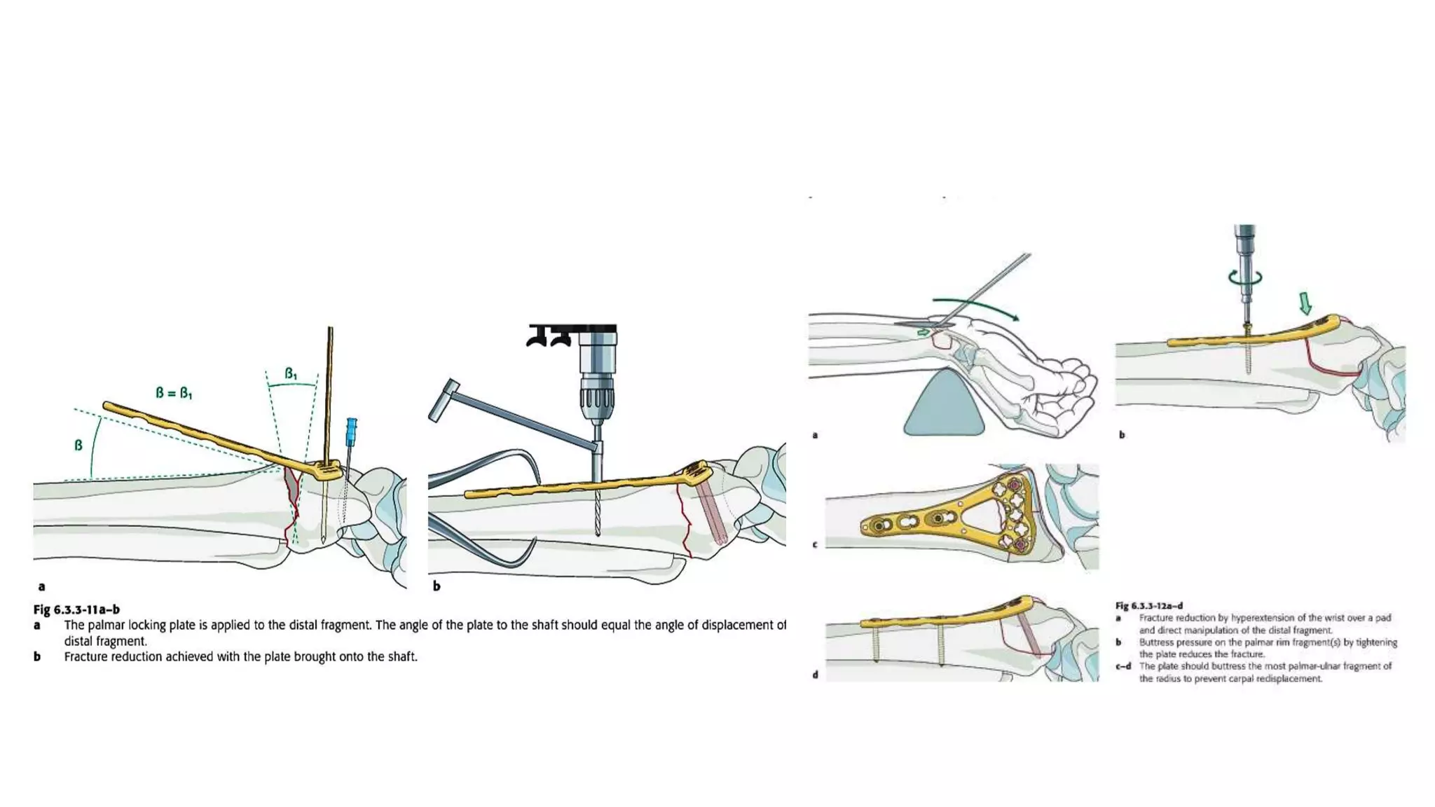 DISTAL END OF RADIUS FRACTURE AND DISLOCATION MANAGEMENT.pptx