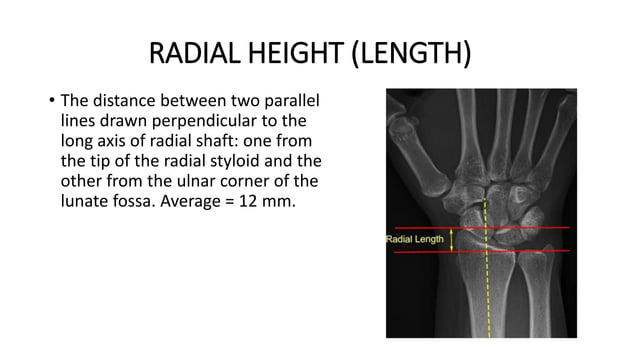 DISTAL END OF RADIUS FRACTURE AND DISLOCATION MANAGEMENT.pptx | Death ...