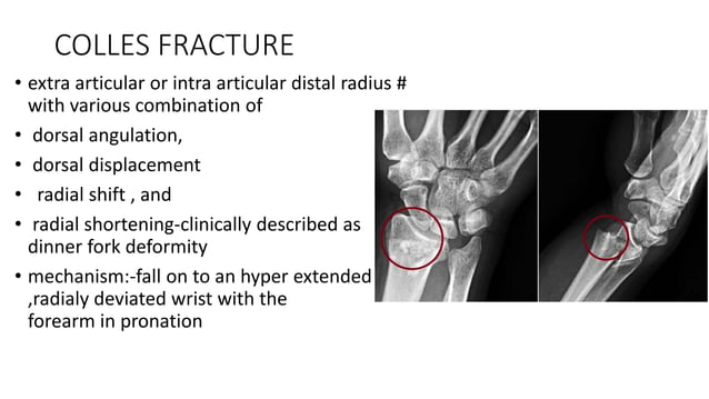 DISTAL END OF RADIUS FRACTURE AND DISLOCATION MANAGEMENT.pptx | Death ...