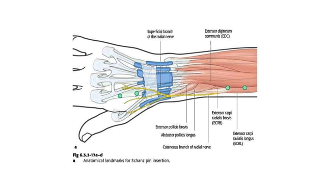 DISTAL END OF RADIUS FRACTURE AND DISLOCATION MANAGEMENT.pptx | Death ...