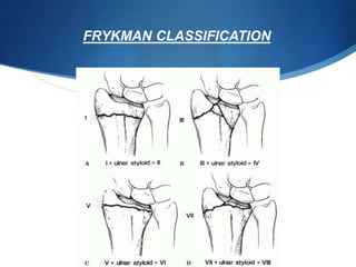 Distal end of radius fractures dr.harish | PPTX