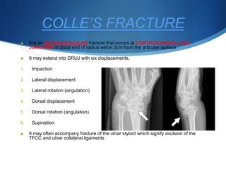 Distal end of radius fractures dr.harish | PPTX