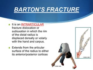 Distal end of radius fractures dr.harish | PPTX