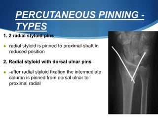 Distal end of radius fractures dr.harish | PPTX