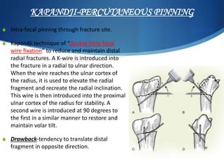 Distal end of radius fractures dr.harish | PPTX