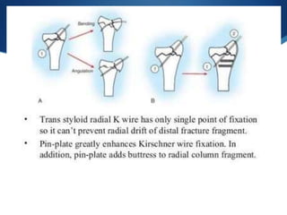 Distal end of radius fractures dr.harish | PPTX