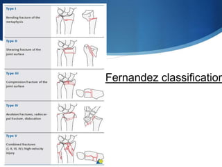 Distal end of radius fractures dr.harish | PPT