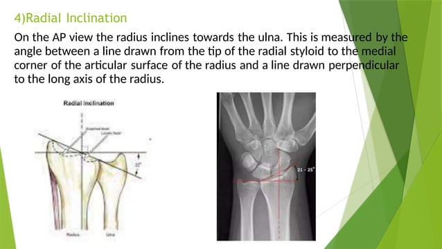 distal end radius fracture presentation.pptx