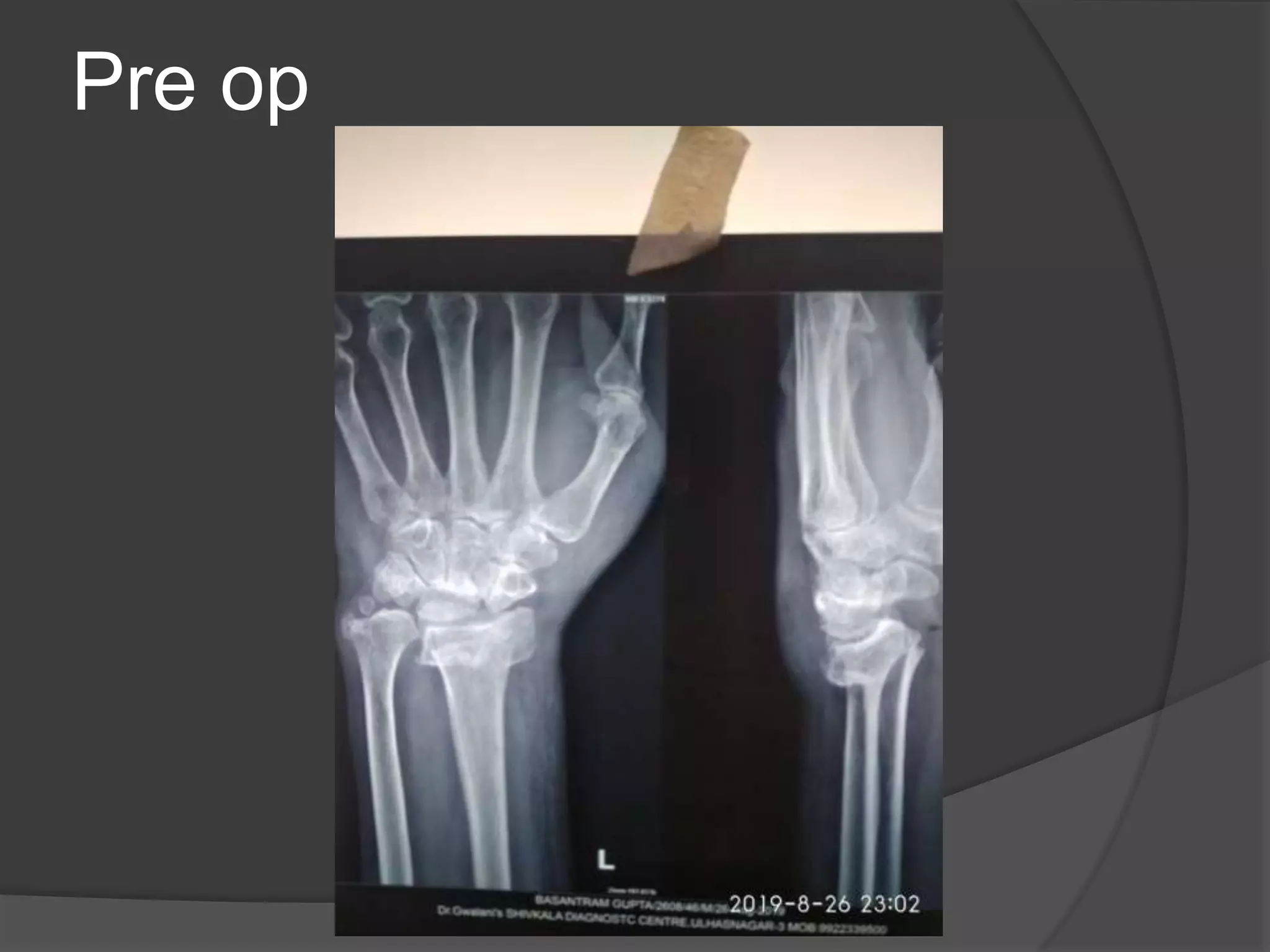 Distal end radius fractures management | PPTX