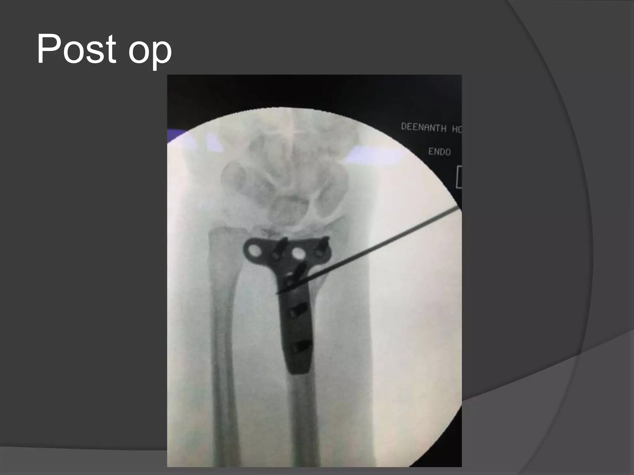 Distal end radius fractures management | PPTX