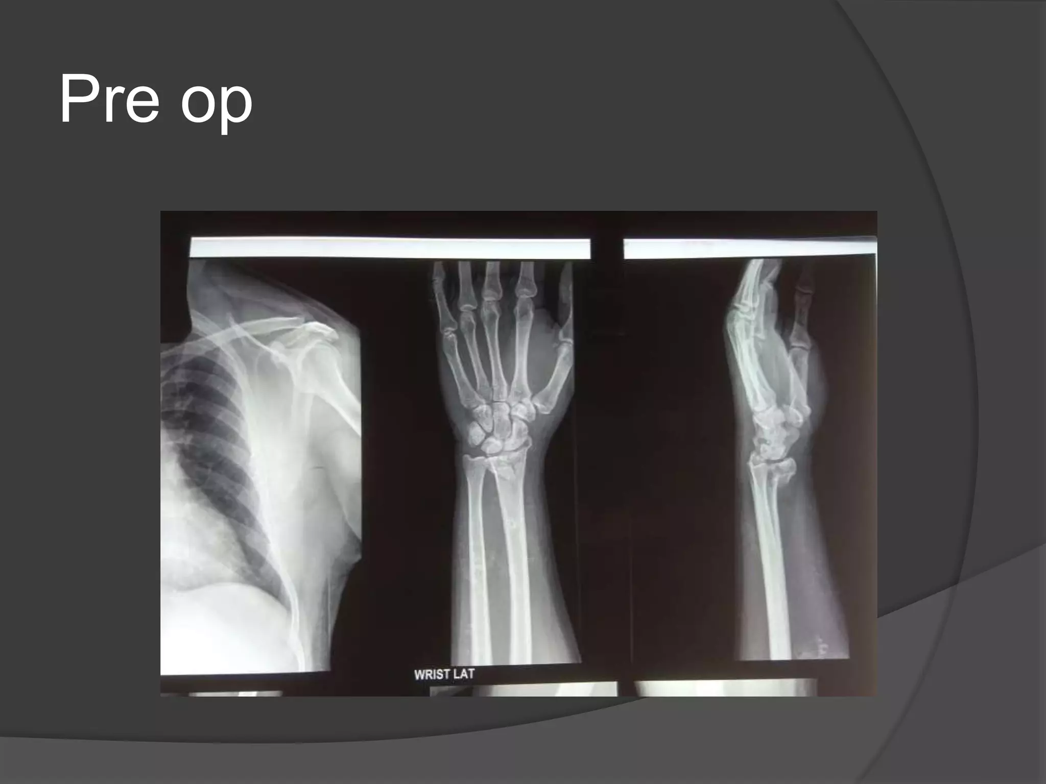 Distal end radius fractures management | PPTX