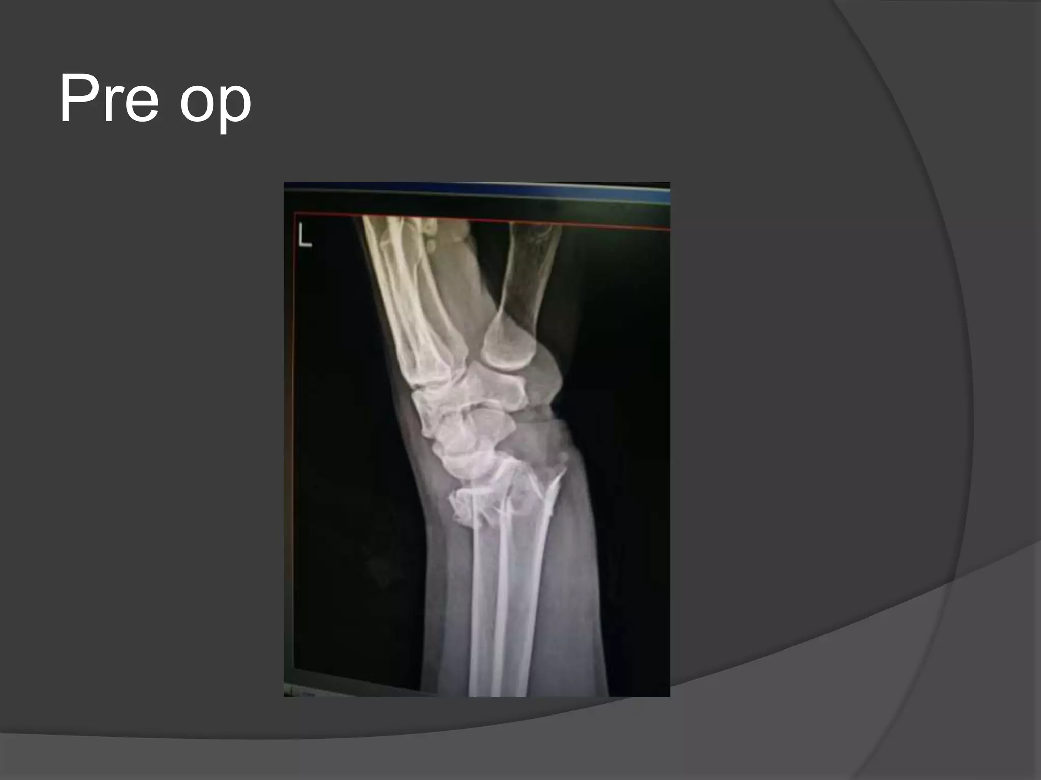 Distal end radius fractures management | PPTX
