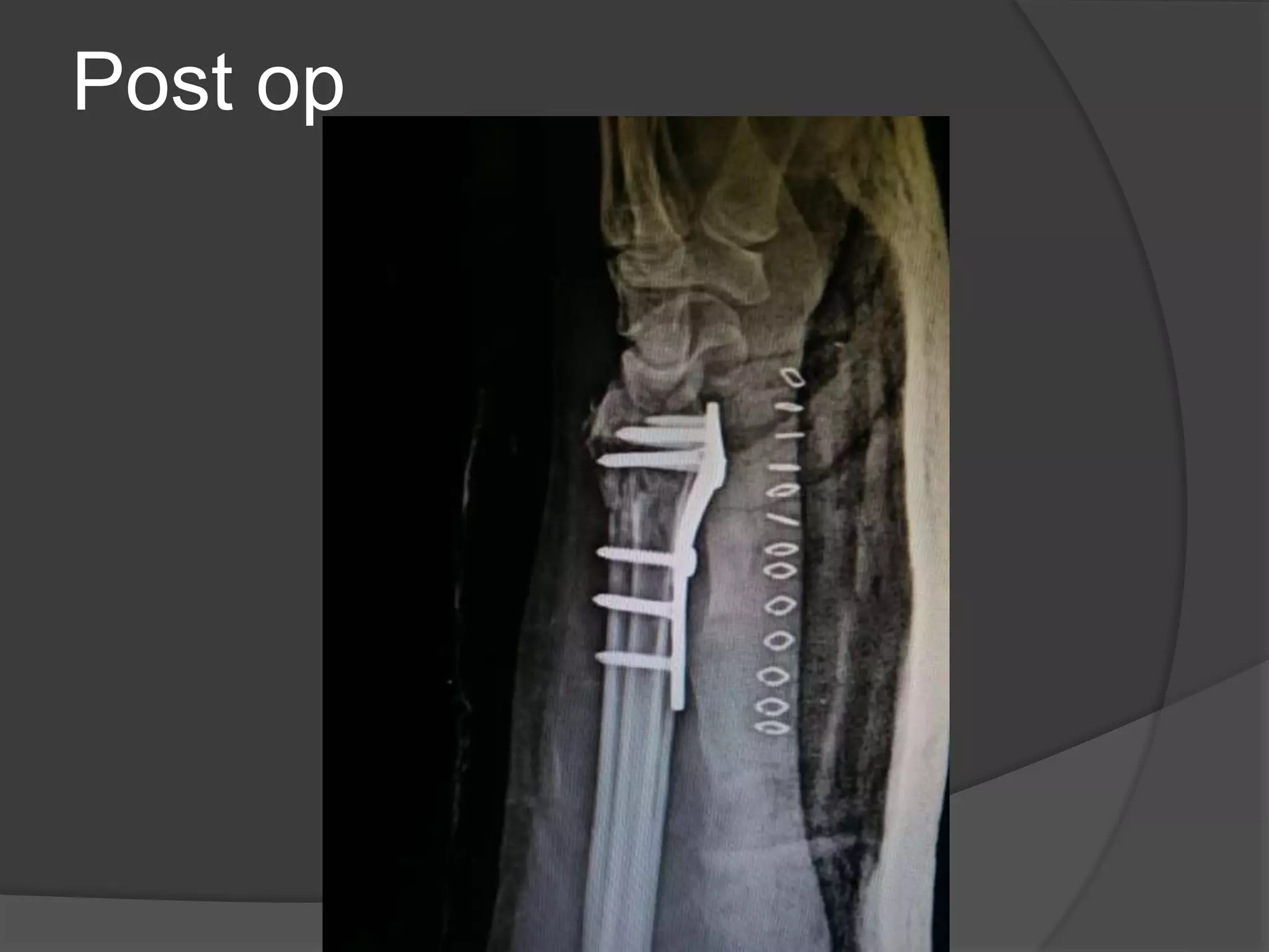 Distal end radius fractures management | PPTX