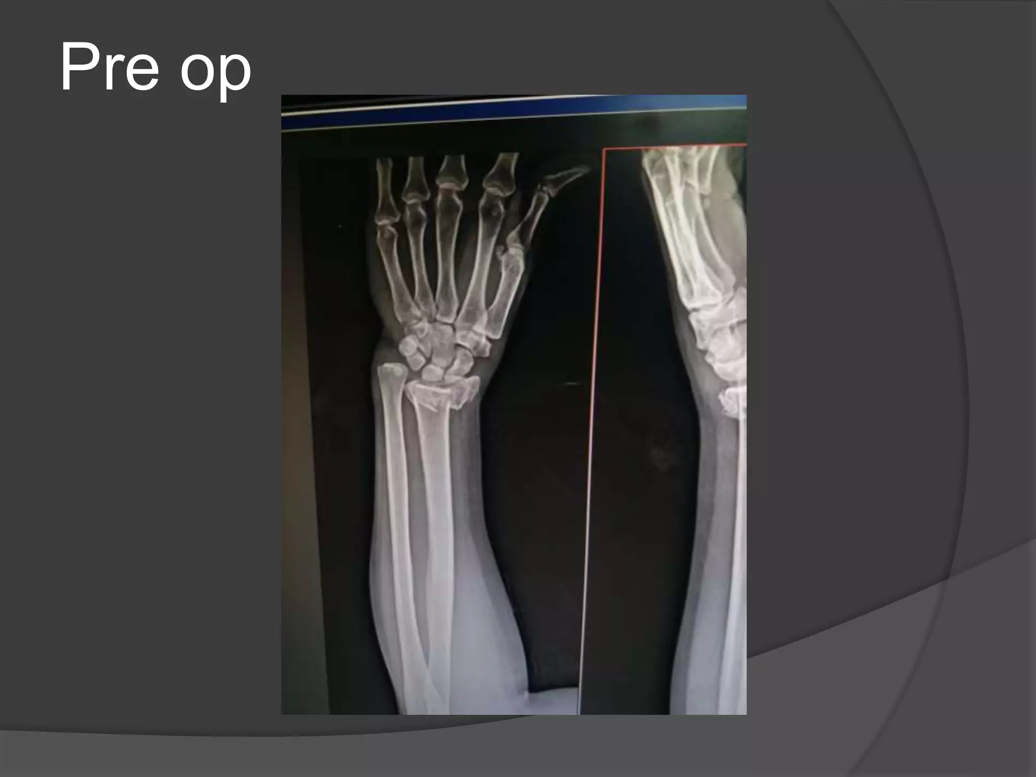 Distal end radius fractures management | PPTX