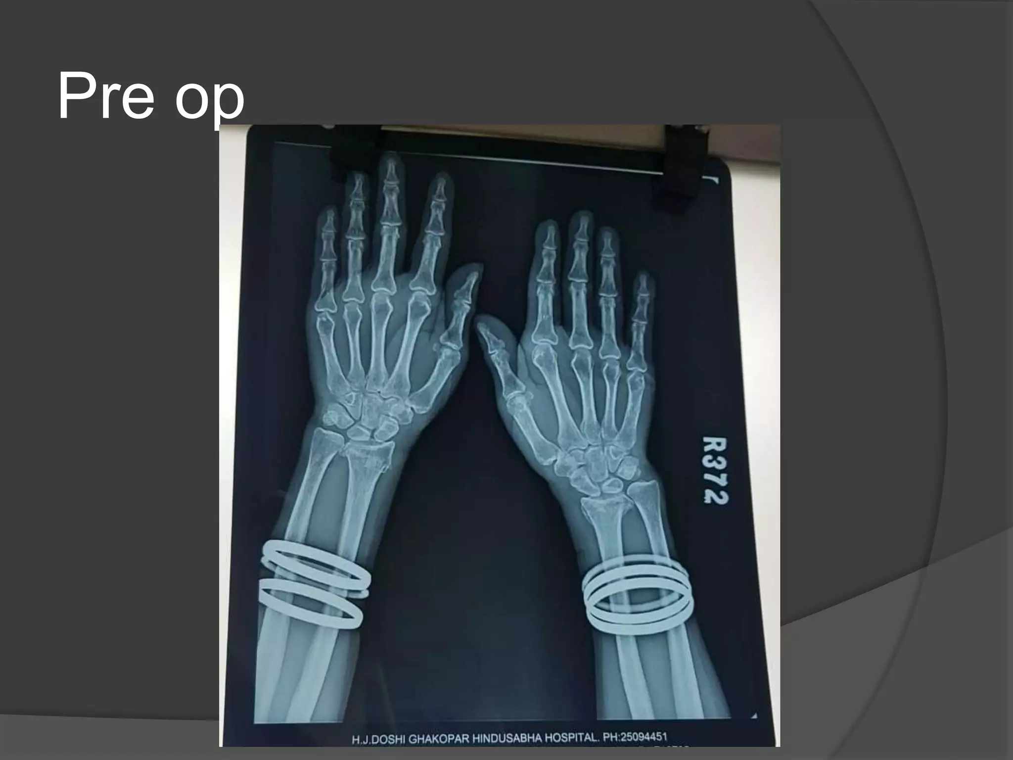 Distal end radius fractures management | PPTX