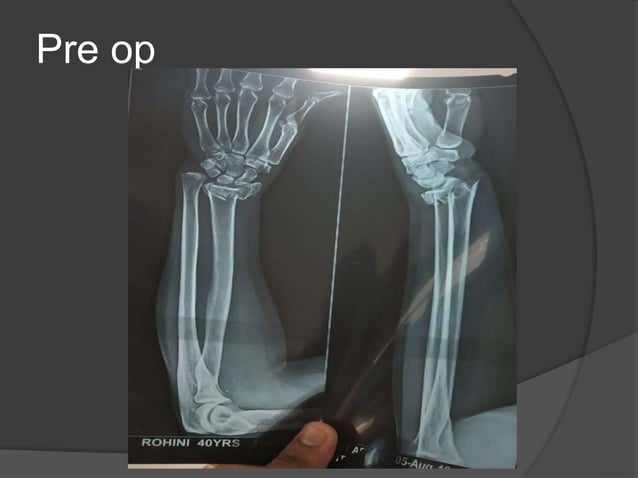 Distal end radius fractures management | PPT