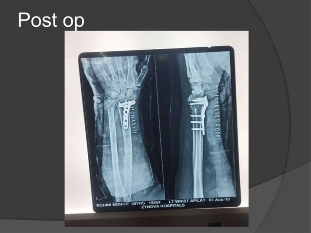 Distal end radius fractures management | PPT