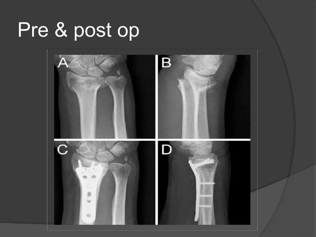 Distal end radius fractures management | PPT