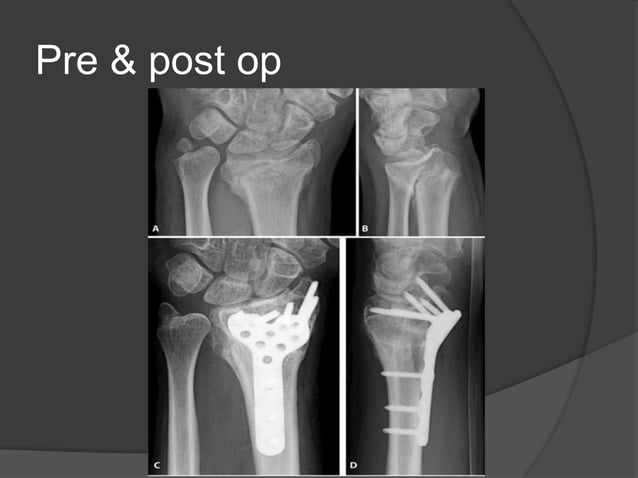 Distal end radius fractures management | PPT
