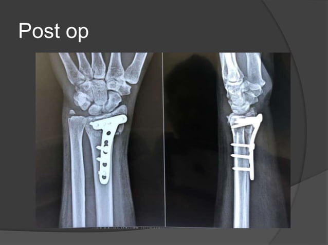 Distal end radius fractures management | PPT