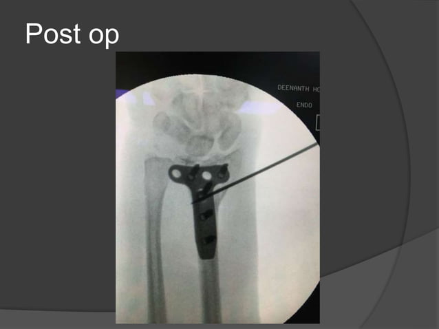 Distal end radius fractures management | PPT